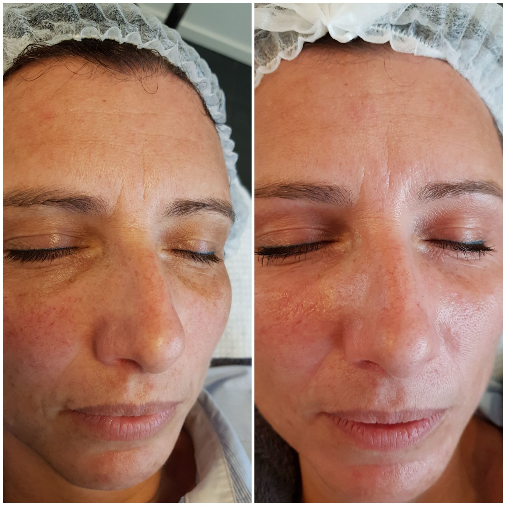 MeLine en pigment - JV Clinic